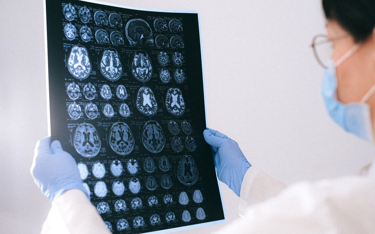 Is Traumatic Brain Injury Permanent? | The Orlow Firm